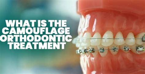 How To Tackle Class Iii Cases With Camouflage Orthodontics Amanda