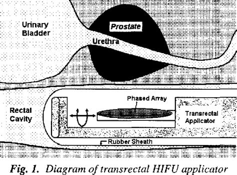 Figure 10 From Design Of Focused Ultrasound Phased Arrays For Prostate Treatment Semantic Scholar