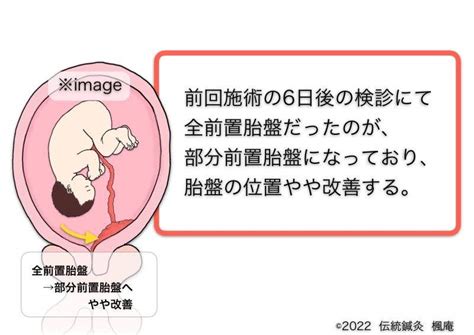 【治療日誌】全前置胎盤3 No2｜伝統鍼灸 楓庵