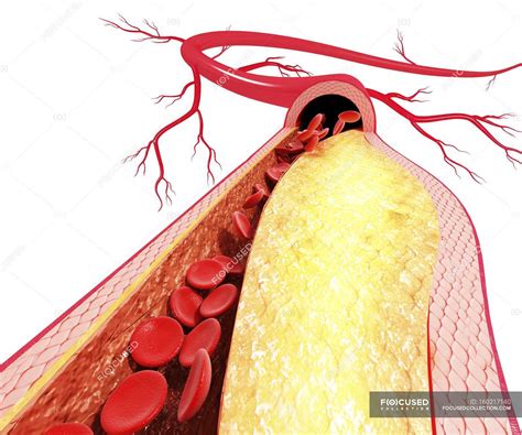 Cholesterol Plaque Leading To Atherosclerosis — Blood Vessel Detail