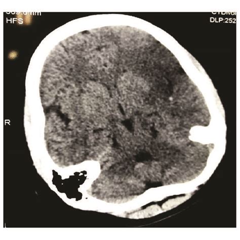 Computed Tomography Of Head Showed Hypodensity At Left Download Scientific Diagram