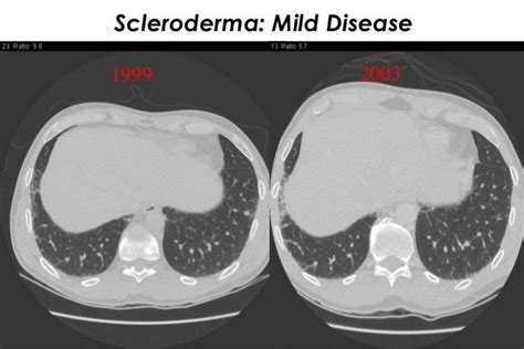 Update On Scleroderma And The Lung