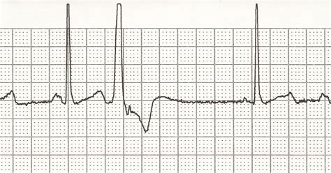 Float Nurse Ekg Rhythm Strips 24 Ectopic Beats