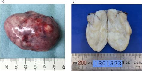 Macroscopic Findings Of The Resected Specimen A The Resected