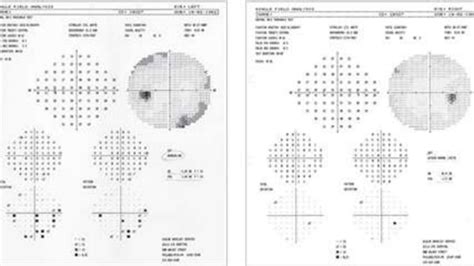 Unilateral Optic Disc Swelling Ppt
