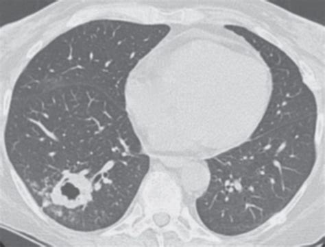 Spiculated Lung Nodule At Brayden Ologhlin Blog