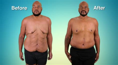 Season 2 Before And After Atlanta Plastic Lifetime
