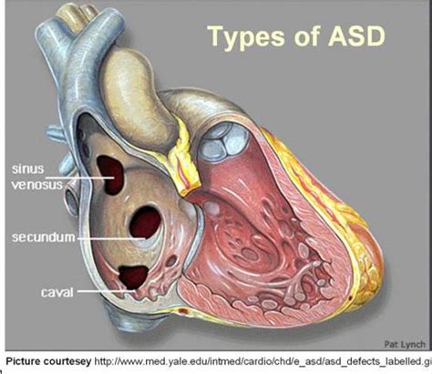 Asd Svc Asd Sinus Venosus Drsvenkatesan Md