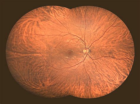 Retinal Imaging Optometrist Eye Doctor In Toronto Clairhurst Eye Care