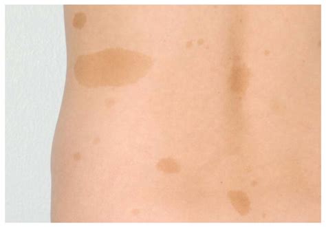 Cafe Au Lait Spots Appearance Causes Treatment 48 Off