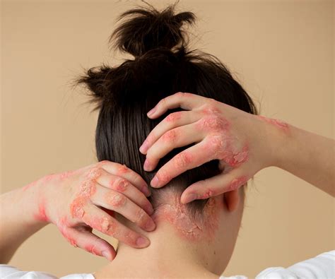 Organic Treatment Balm For Psoriasis A Holistic Approach Supersalve