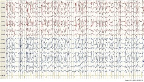 Estado Epiléptico De Ausencia En Ancianos Con Epilepsia Generalizada