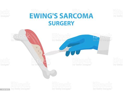Ewing의 육 종 수술 벡터 일러스트 평면 디자인에 흰색 배경에 고립 외과 의사 S 의료 Infographic 요소 손을 유지