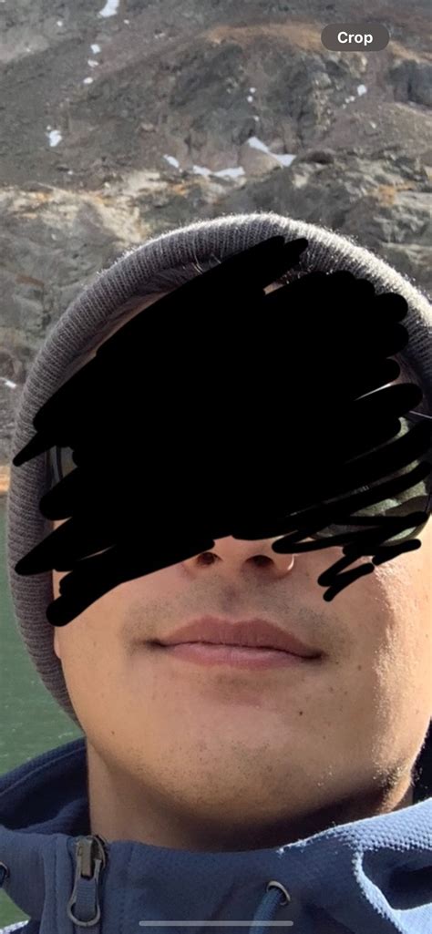 [personal] Advice Help For Healing Minimizing Scars On Lip R