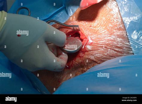 Pacemaker Implantation Surgery In Progress A Pacemaker Being Inserted Into The Chest Cavity Of