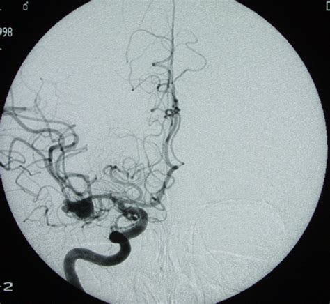 Aneurysma Angiographie P A Doccheck
