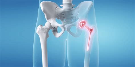 Recovery After Hip Replacement Surgery Hip Operation Recovery Time Dr Ashwini Gaurav