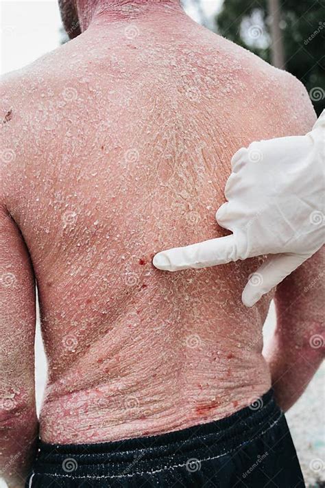 Doctor Examining Patient With Psoriasis On Back Closeup Outdoor Stock