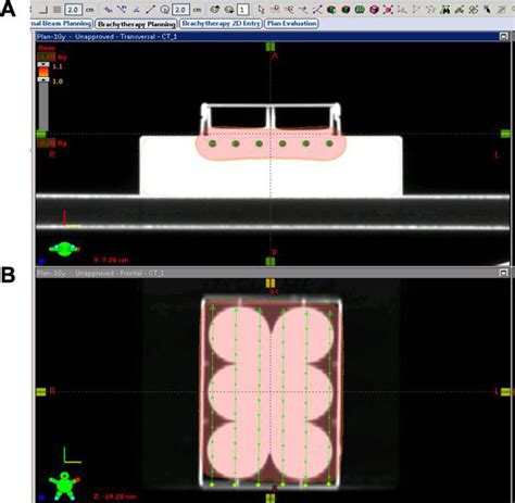 Dose Uniformity Validated Using Eclipse ® 3d Dose Planning Software