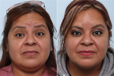 Xeomin Botox® Cosmetic Photos Houston Tx Patient 47184