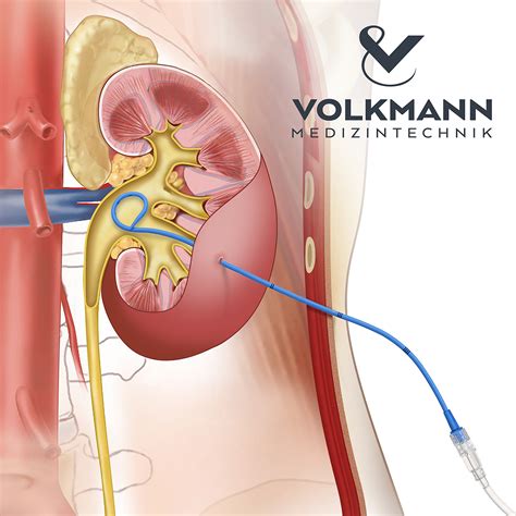 Percutaneous Nephrostomy Sets