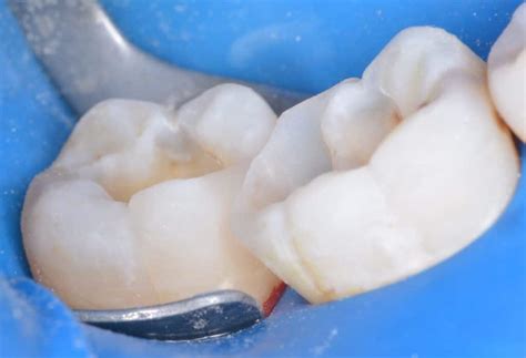 A Recipe For Class Ii Composite Restoration Myzerodonto