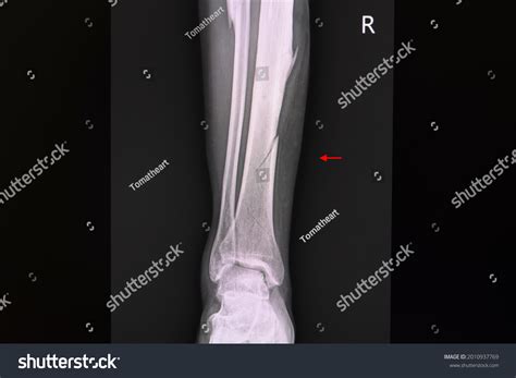 Broken Tibia Images Stock Photos Vectors Shutterstock