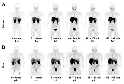 Series Of Whole Body Maximum Intensity Projection Images Of