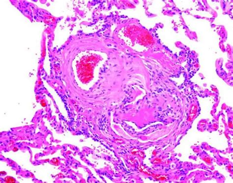 Interstitial Lung Disease Description Causes Symptoms Diagnosis