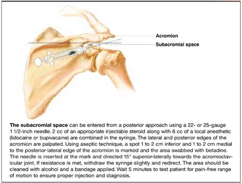 Subacromial Injection