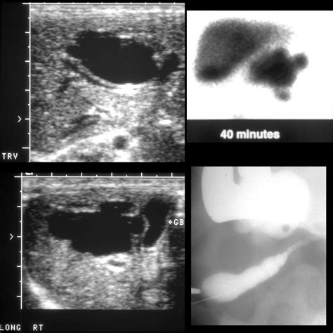 Choledochal Cyst Pediatric Radiology Reference Article Pediatric