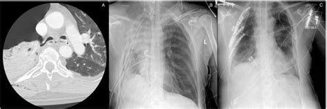 A Axial Ct Showing Complete Transection Of Right Mainstem Bronchus