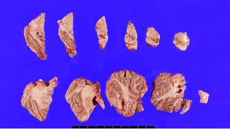 Figure 4 From An Autopsy Proven Case Based Review Of Autoimmune