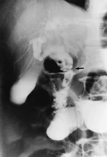 Recurrent Pyogenic Cholangitis Clinical Gate
