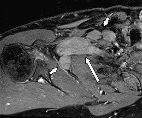 Anatomy Imaging And Pathologic Conditions Of The Brachial Plexus