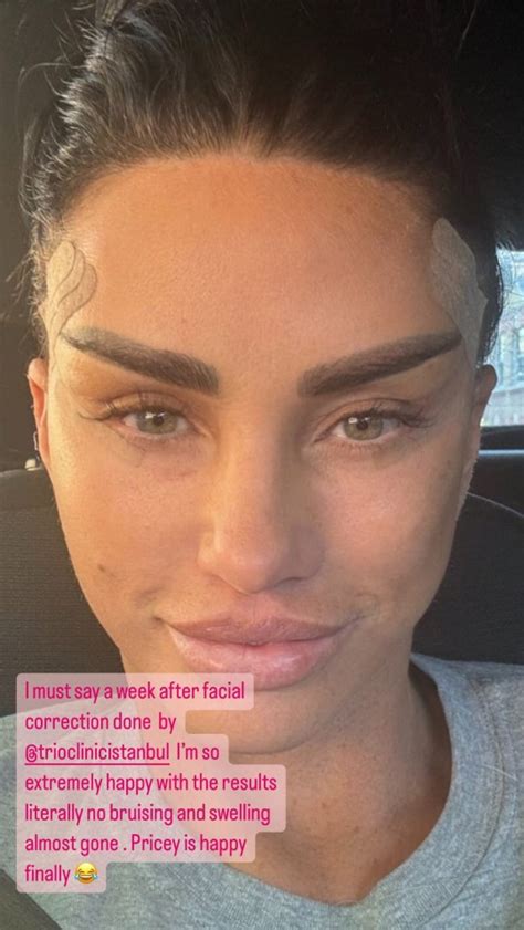 Katie Price Reveals Shes Finally Happy With £10000 Facelift Result