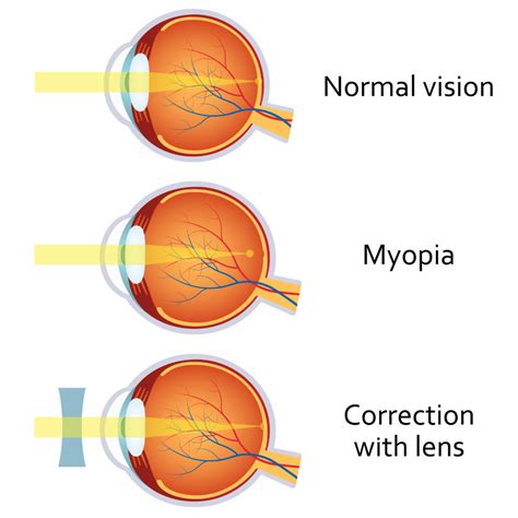 Understanding Refraction And Refractive Errors Eyewa Blog