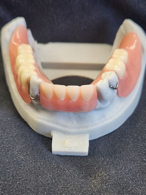 Partial Dentures For Front And Back Teeth What Are My Options