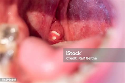 Tonsillar Crypt Debris