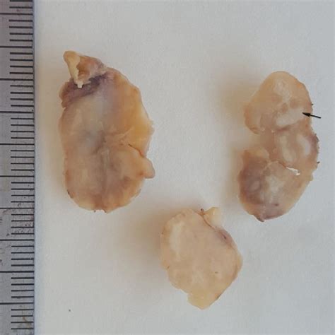 Macroscopic View An Illustrative Case Of Lymph Node Tuberculosis With Download Scientific