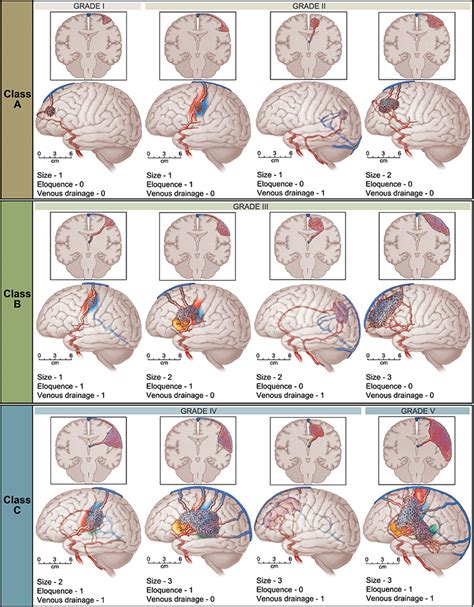 Avm Brain Hemorrhage