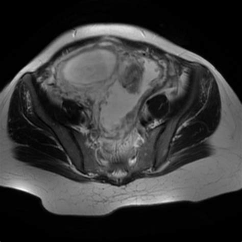 Red Degeneration Of Uterine Fibroids In Pregnancy Image