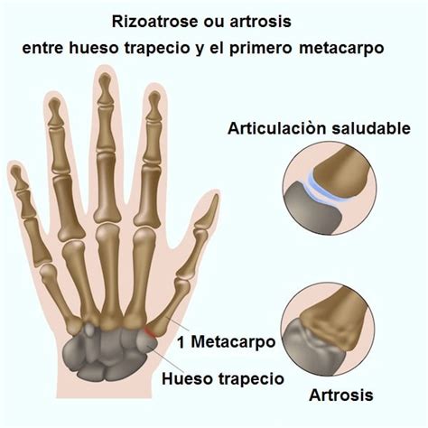 Artrosis De Mano Y Dedos Sintomas Dolor Tratamiento Y Fisioterapia Fisioterapia Para Todos
