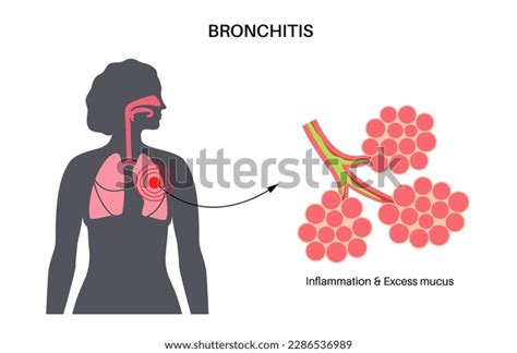 Bronchitis Concept Infection Lungs Bronchi Anatomical Stock Vector Royalty Free 2286536989