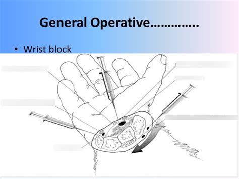 Wrist Block Digital Block And Terminal Nerves Diagram Quizlet