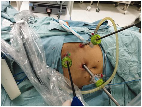 Laparoscopic Nephrectomy Was Performed At This Position But The Ureter