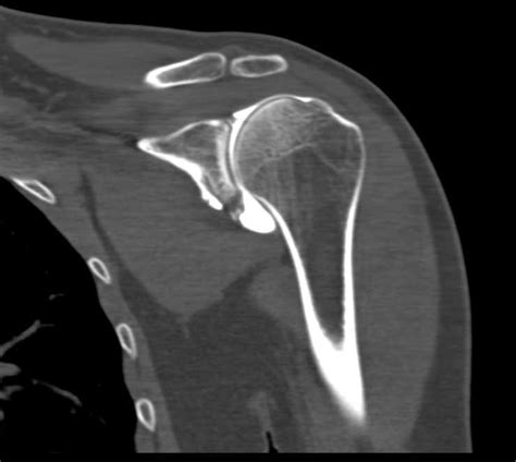 Ct Shoulder Arthrogram In 3d Musculoskeletal Radiology Case Studies