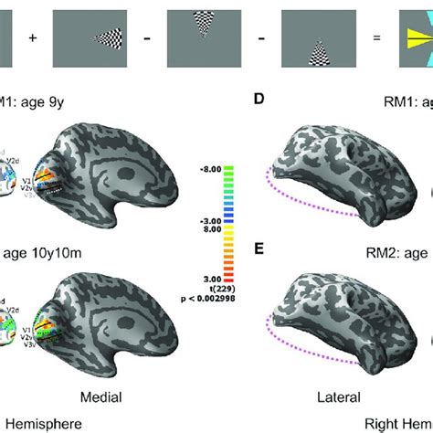 Early Visual Cortex Activation In Ud In Rm1 Age 9 Years And Rm2