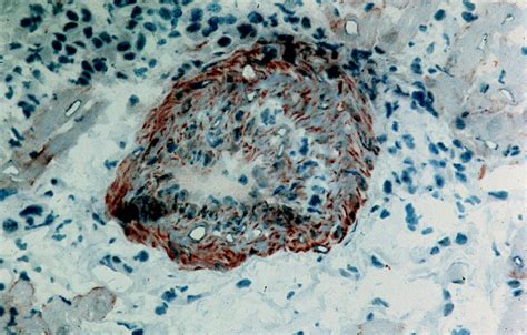 Adhesion Molecule P Selectin And Vascular Cell Adhesion Molecule 1 In Enhanced Heart Allograft