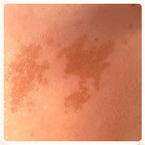 Todo Sobre Las Manchas En La Piel Centro De Estética Elena Somoano